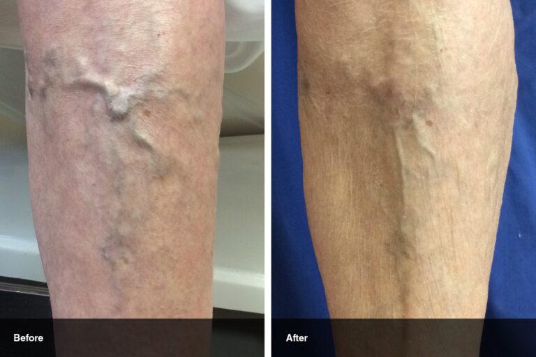 Vein Ablation - Midwest Vein and Laser