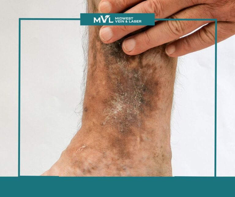 Venous Stasis Ulcer - Midwest Vein and Laser